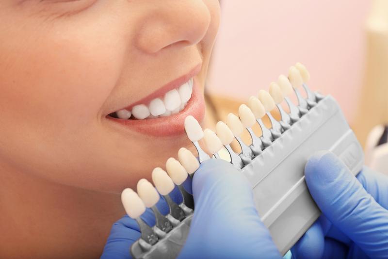 Benefits of Teeth Whitening | Fort Worth, TX Dentists